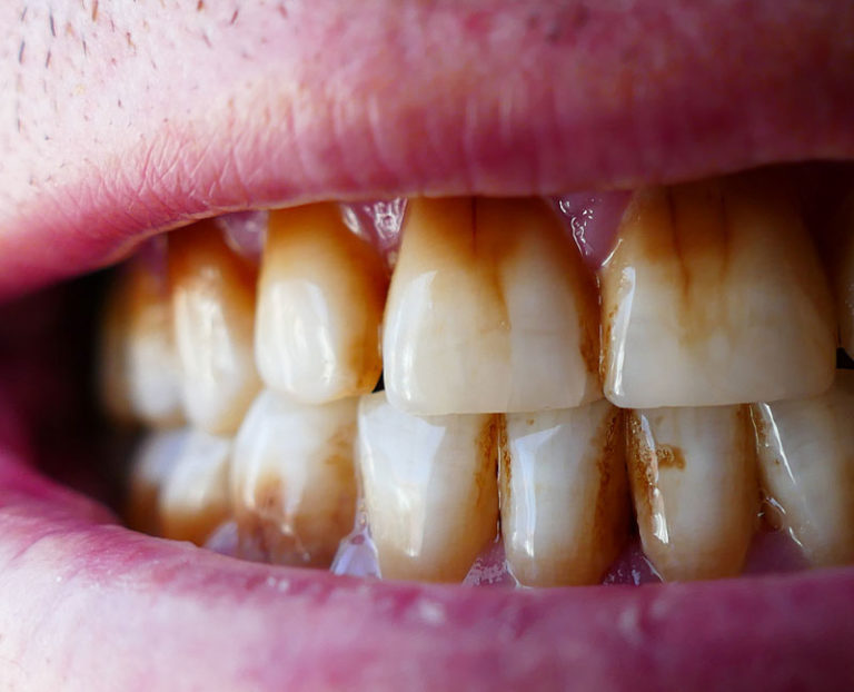 discolored-teeth | Hamburg Dental Care