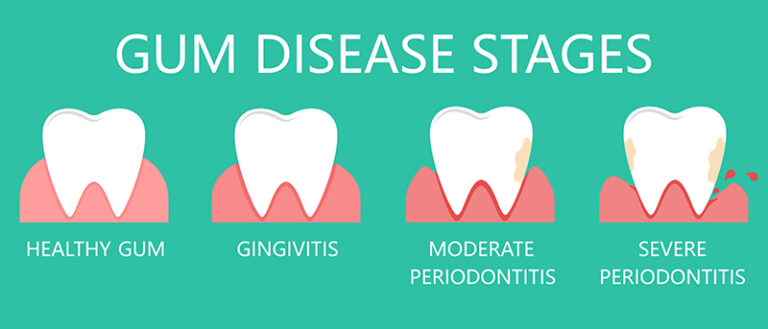 The Link Between Gum Disease and Cancer | Hamburg Dental Care